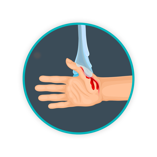 How to Deal with a Sharps Injury